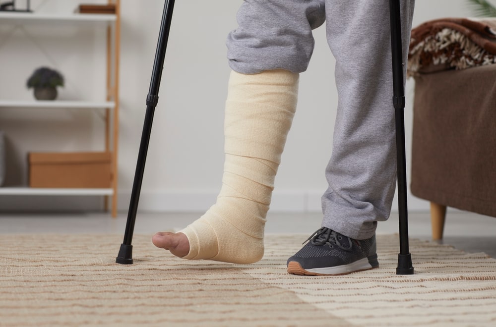 How Much Does a Broken Leg Cost? | 844SeeMike Personal Injury Lawyers ...